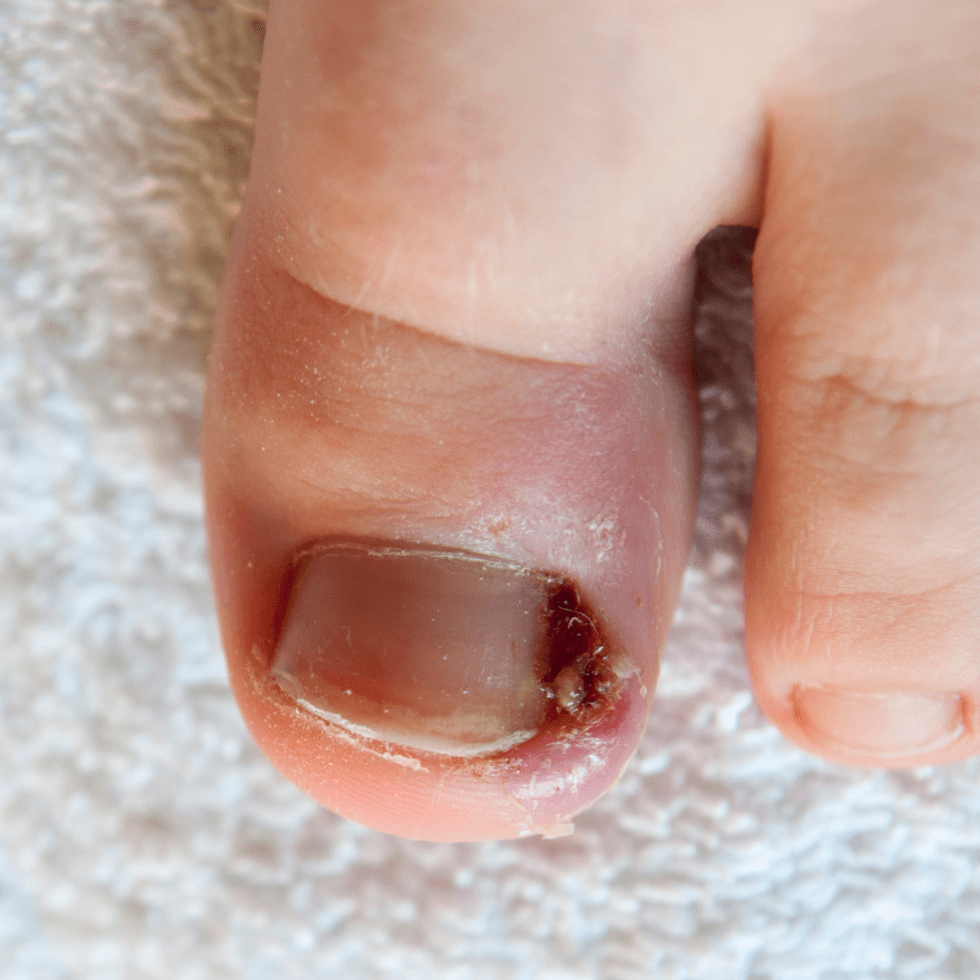 Ingrown Toenails - The Foot Health Centre | Chiropodist - Foot and ...
