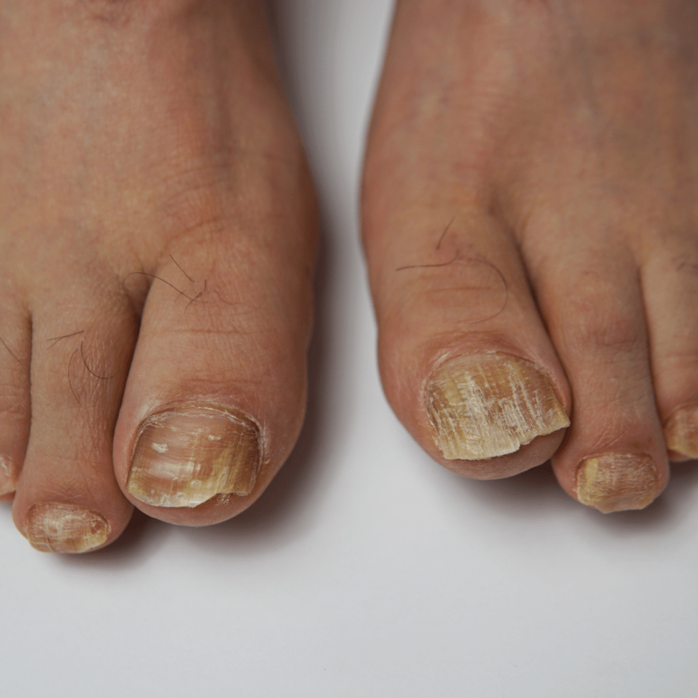 Lunula Laser Treatment for Toenail Fungus - The Foot Health Centre ...